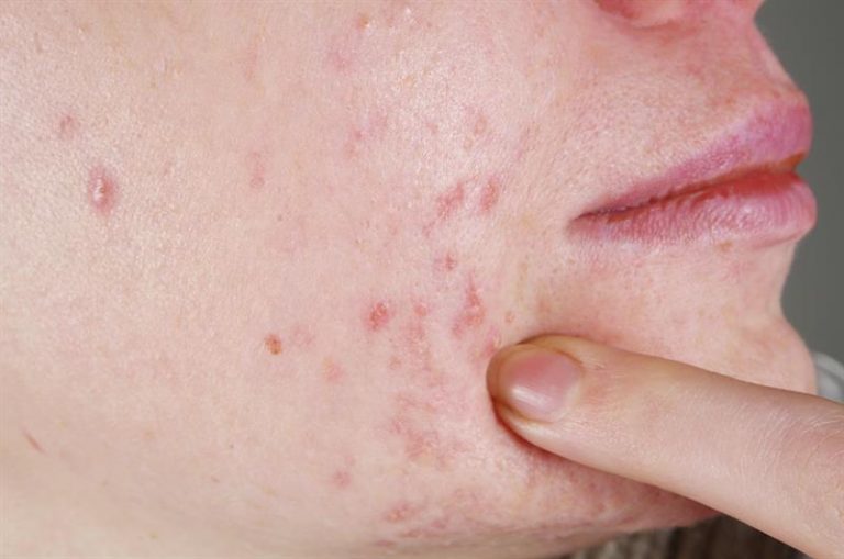 Tratamientos de Acné en Córdoba y Jaén | Dermatólogos Fdez. Crehuet