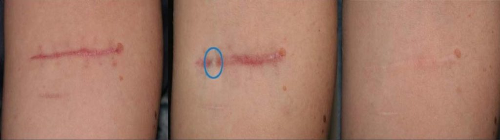 LASER Nordlys™ - Dermatólogos Fernández-Crehuet